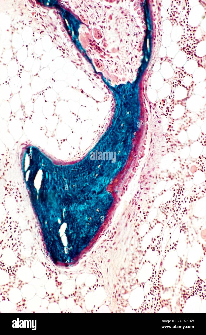 Renal bone disease. Light micrograph of a section through bone from a ...