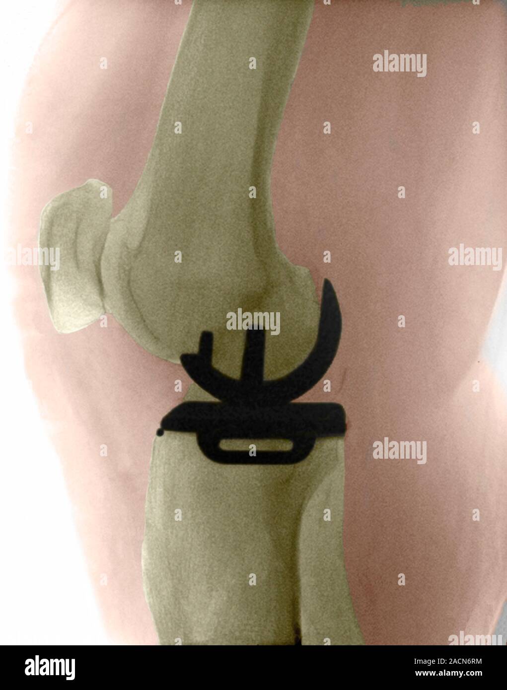 Coloured X-ray of the side view of a partial knee replacement fitted in ...