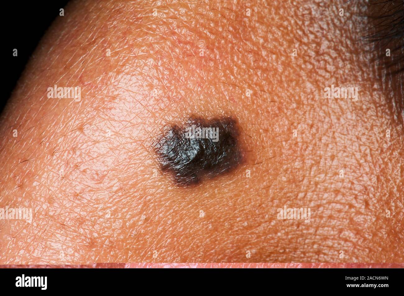 Pigmented skin mole. Pigmented naevus or mole on the skin of a 24-year ...