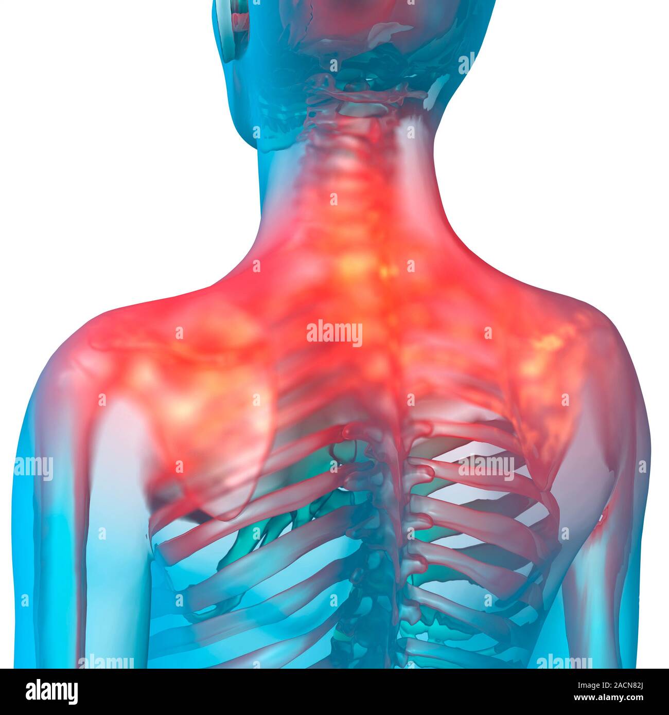 Shoulder pain, computer artwork Stock Photo - Alamy