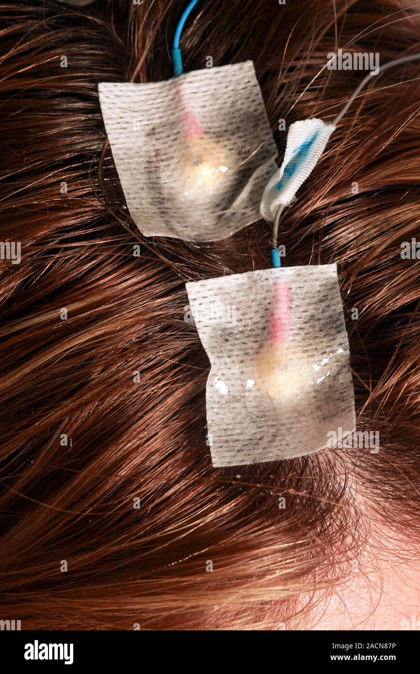Electroencephalography (EEG) electrodes on girls scalp. EEG measures ...