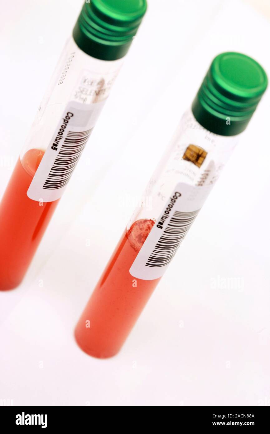 Stool samples in specimen tubes. Stool samples are used to diagnose a ...