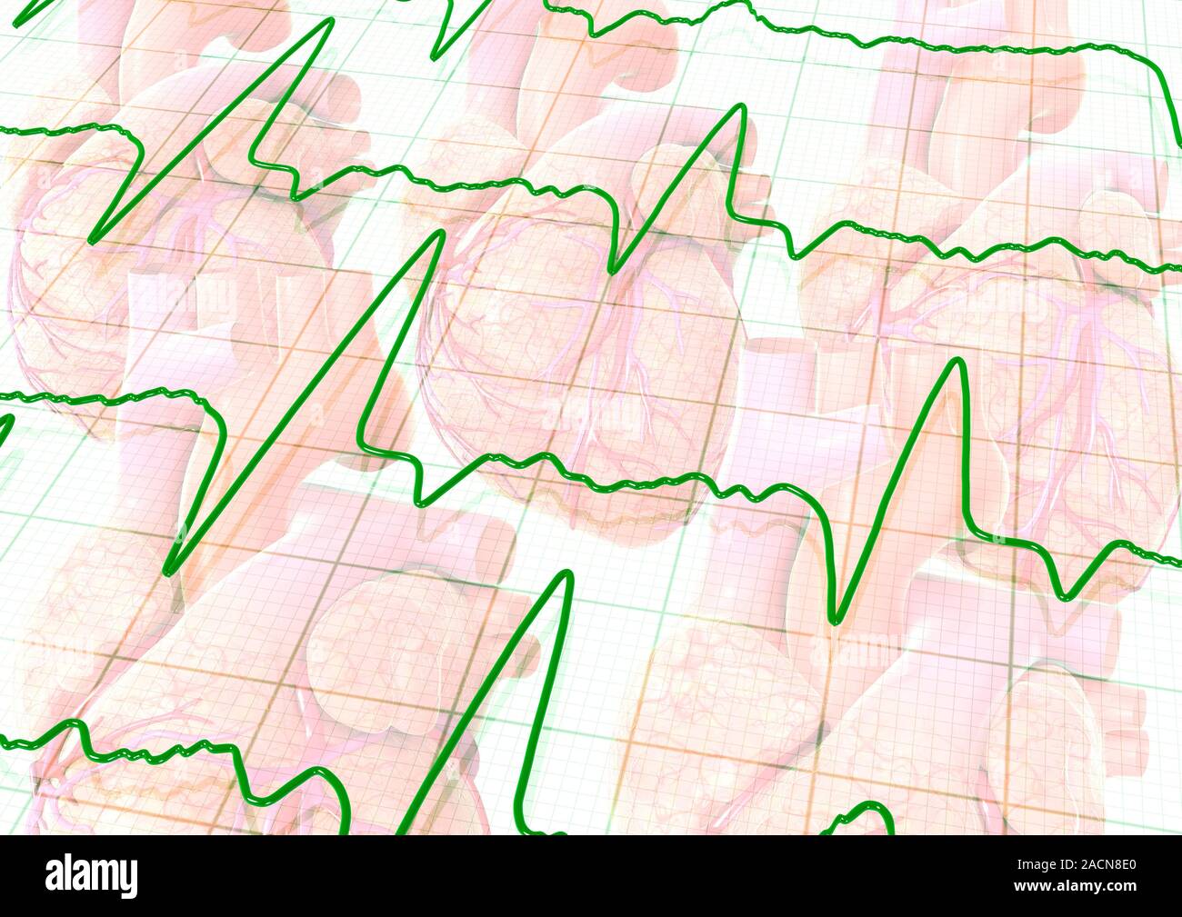 Irregular heart beat, conceptual image. Computer artwork of ECG ...