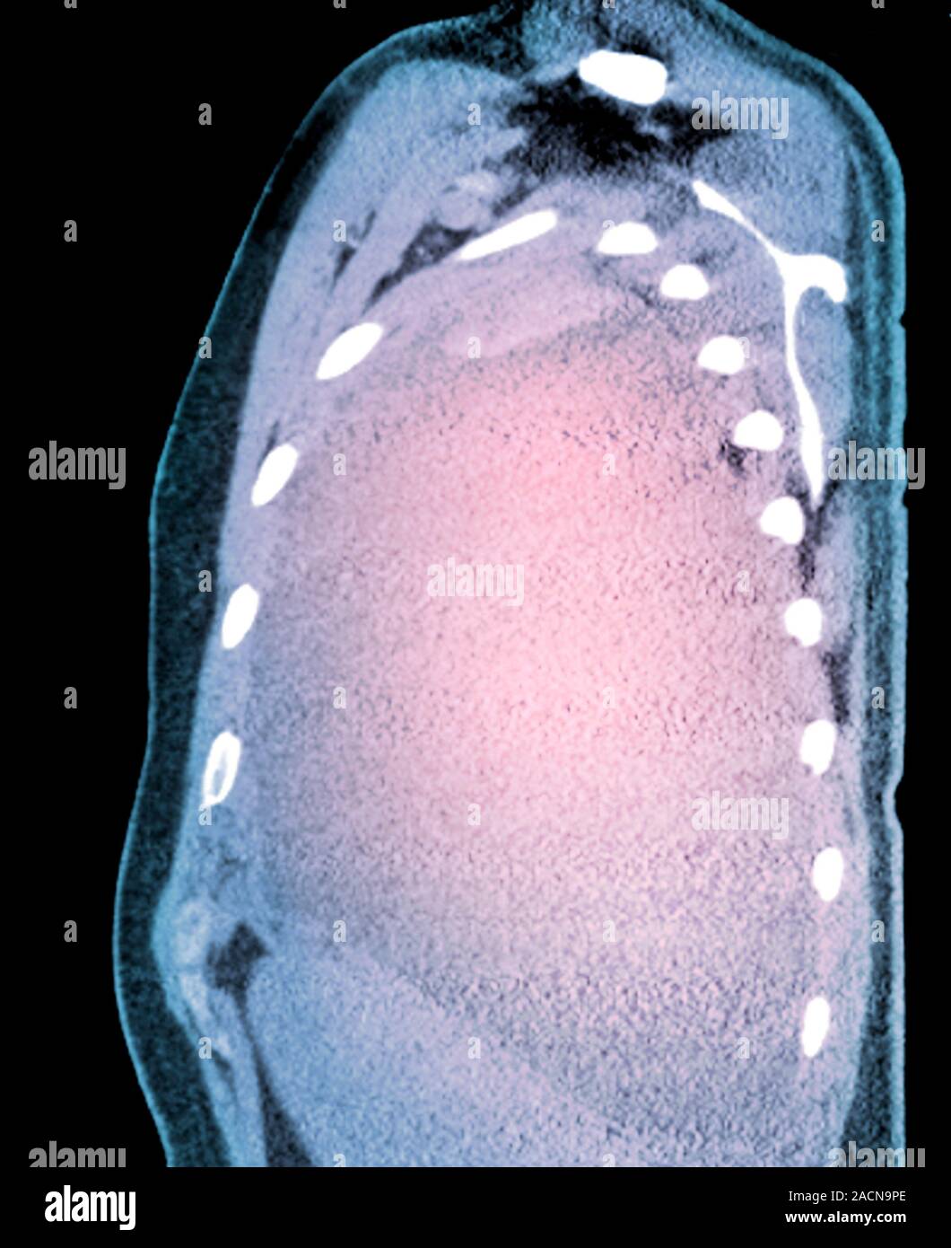 Pleural effusion in mesothelioma. Coloured computed tomography (CT ...