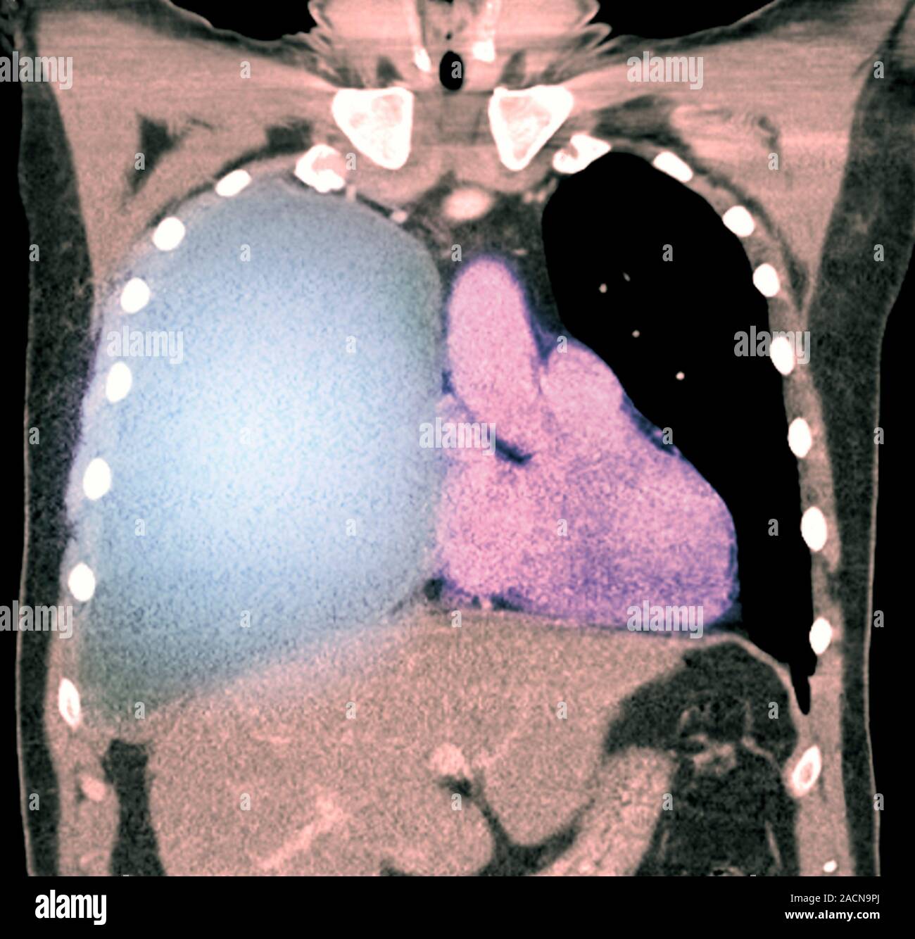 Pleural effusion in mesothelioma. Coloured computed tomography (CT scan ...