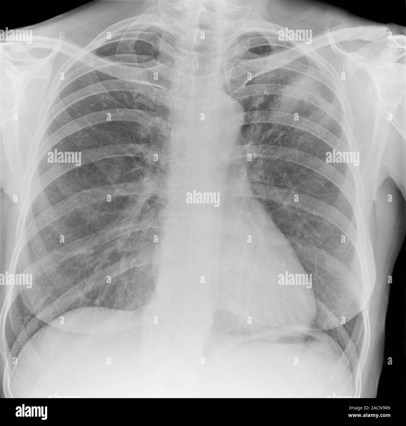 Lung cancer. X-ray (front view) of the chest in a 60 year old female ...