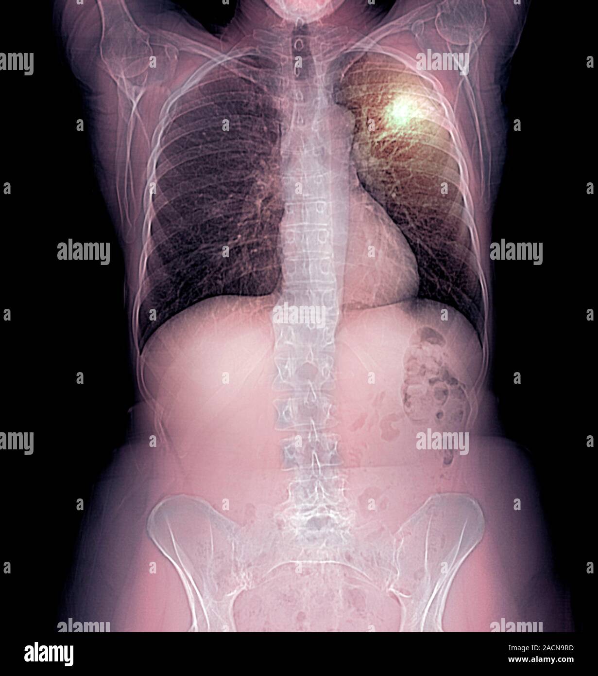 Lung cancer. Coloured X-ray (front view) of the chest and abdomen of a ...