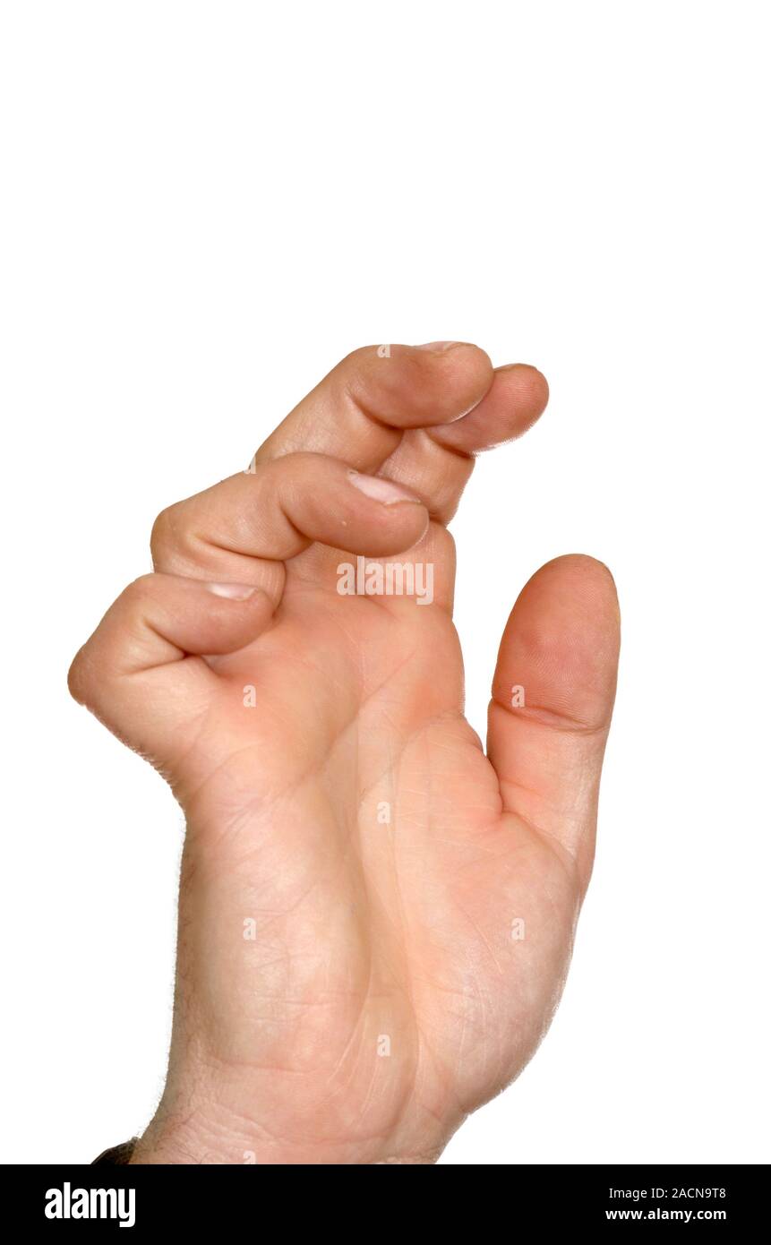 Not for use in Television Not for use in Television Claw-hand due to ...