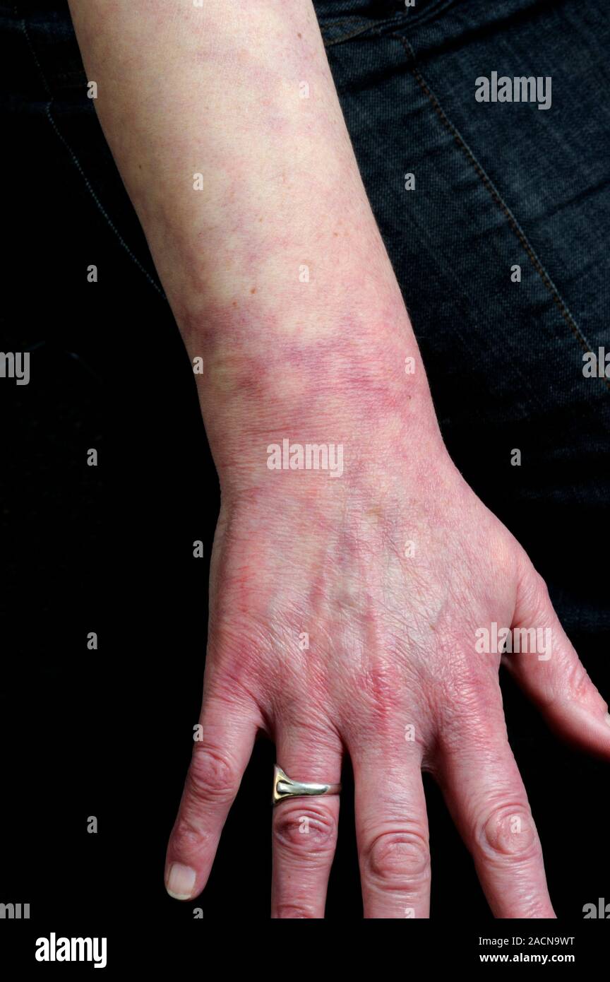 Not for use in Television Not for use in Television Livedo reticularis ...