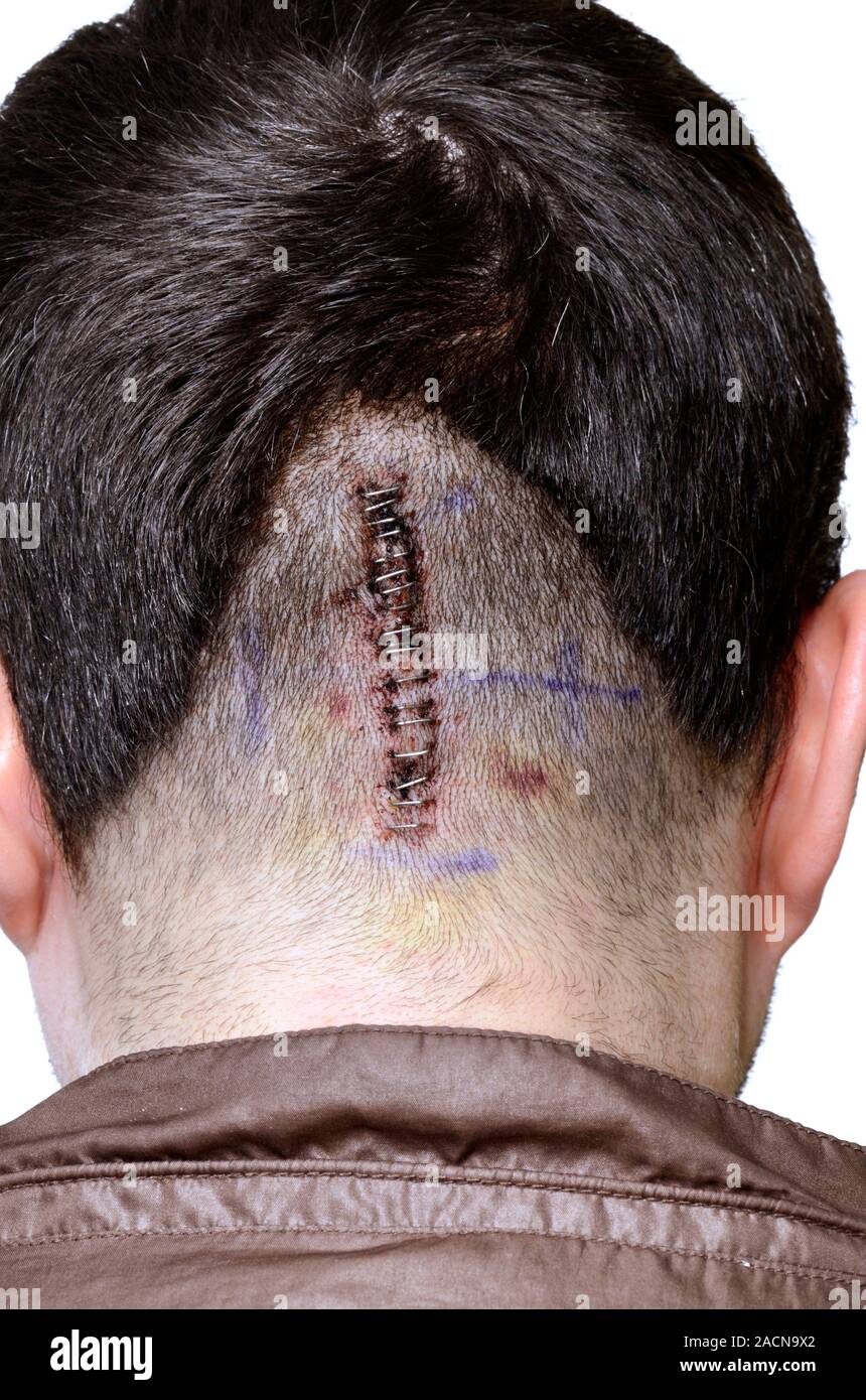 Not for use in Television Not for use in Television Wound from nerve ...