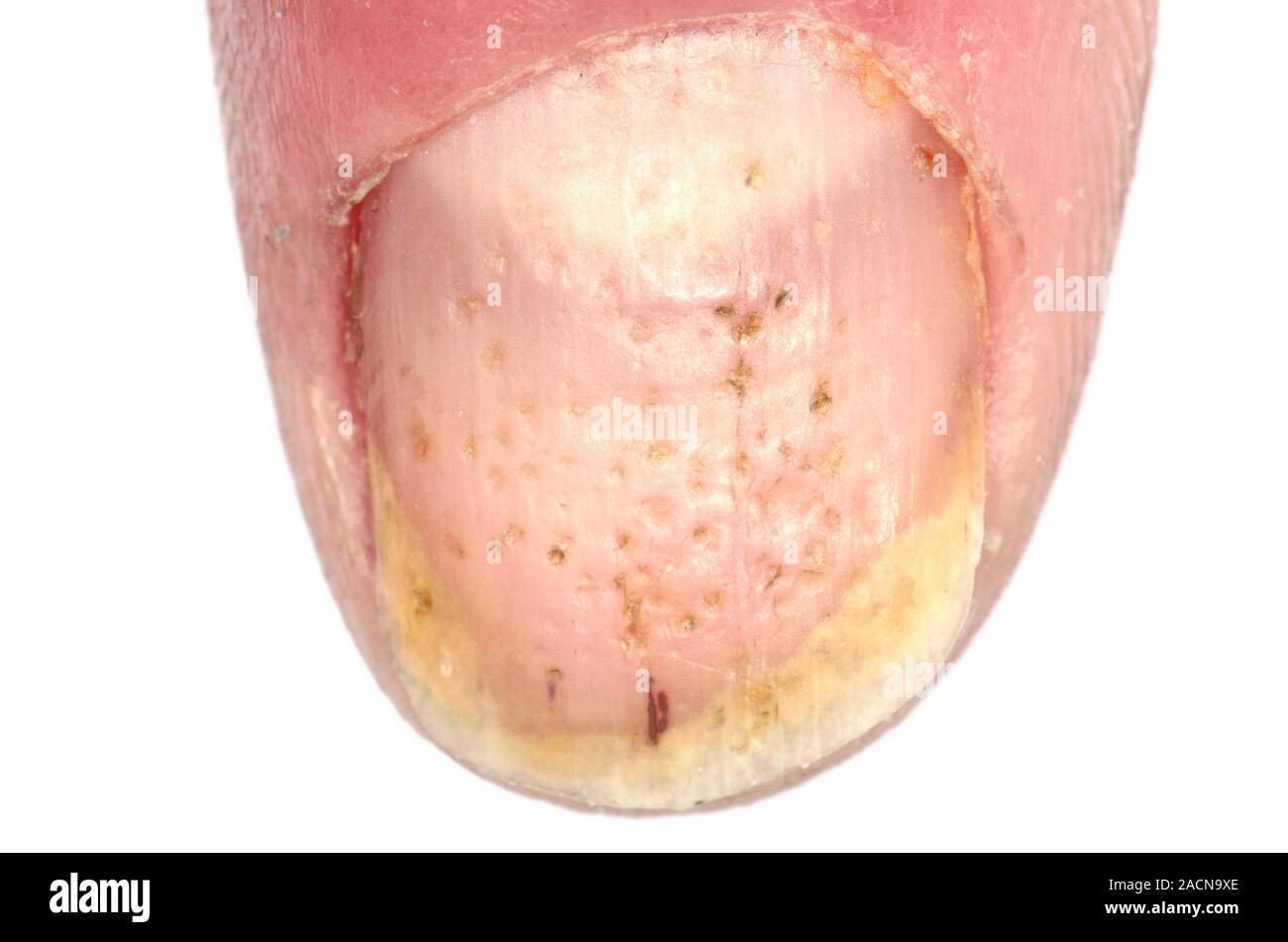 Not for use in Television Not for use in Television Psoriasis of the ...