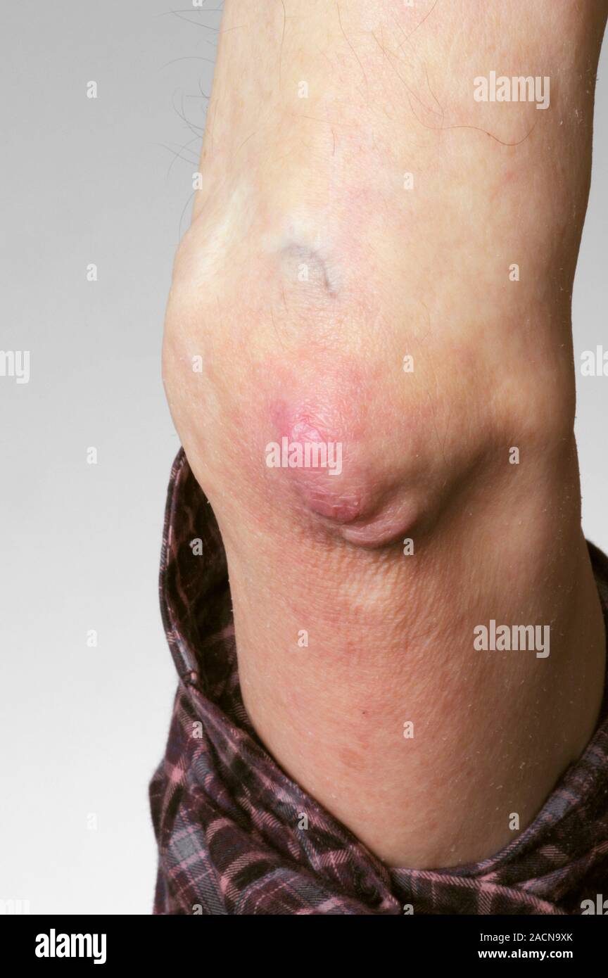 Not for use in Television Not for use in Television Rheumatoid nodule ...