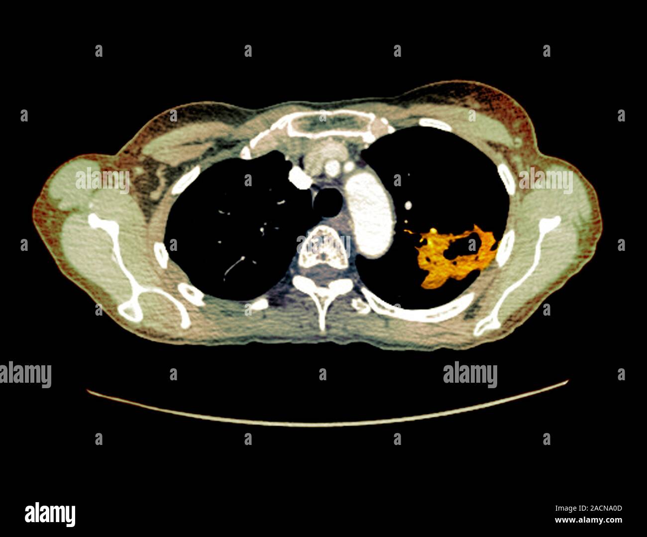 Lung cancer. Coloured Computed tomography (CT) scan of the chest of a 60 year old female patient ...