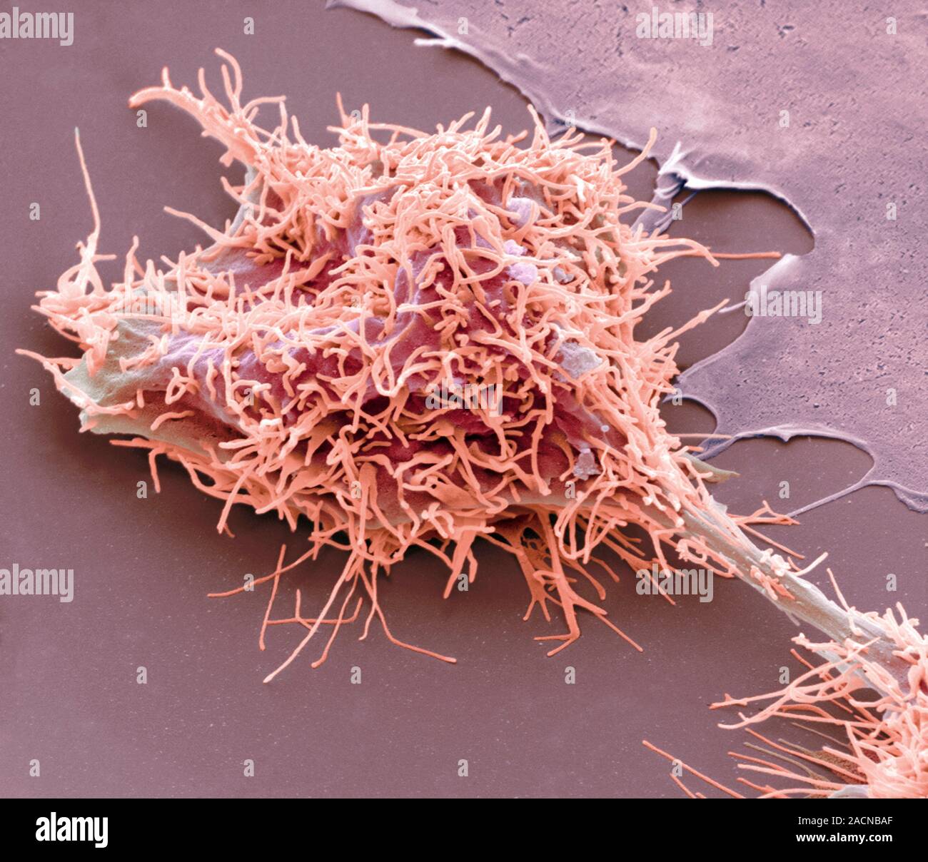 Dividing brain cancer cells. Coloured scanning electron micrograph (SEM ...