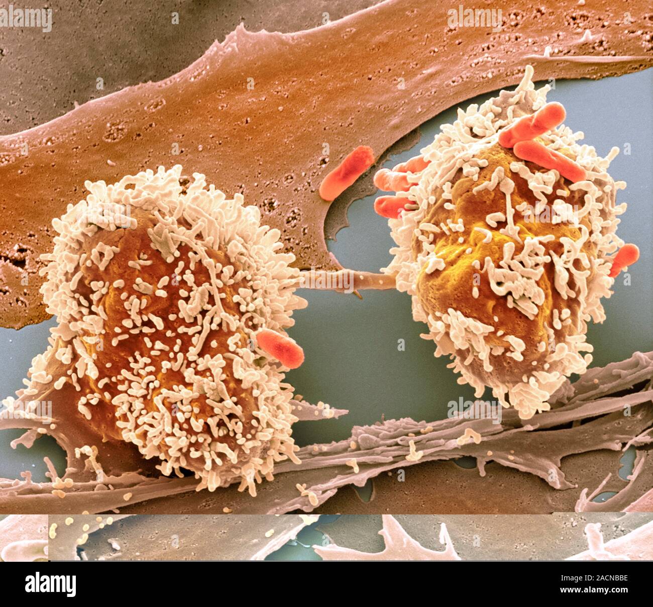 Dividing cancer cell. Coloured scanning electron micrograph (SEM) of a ...