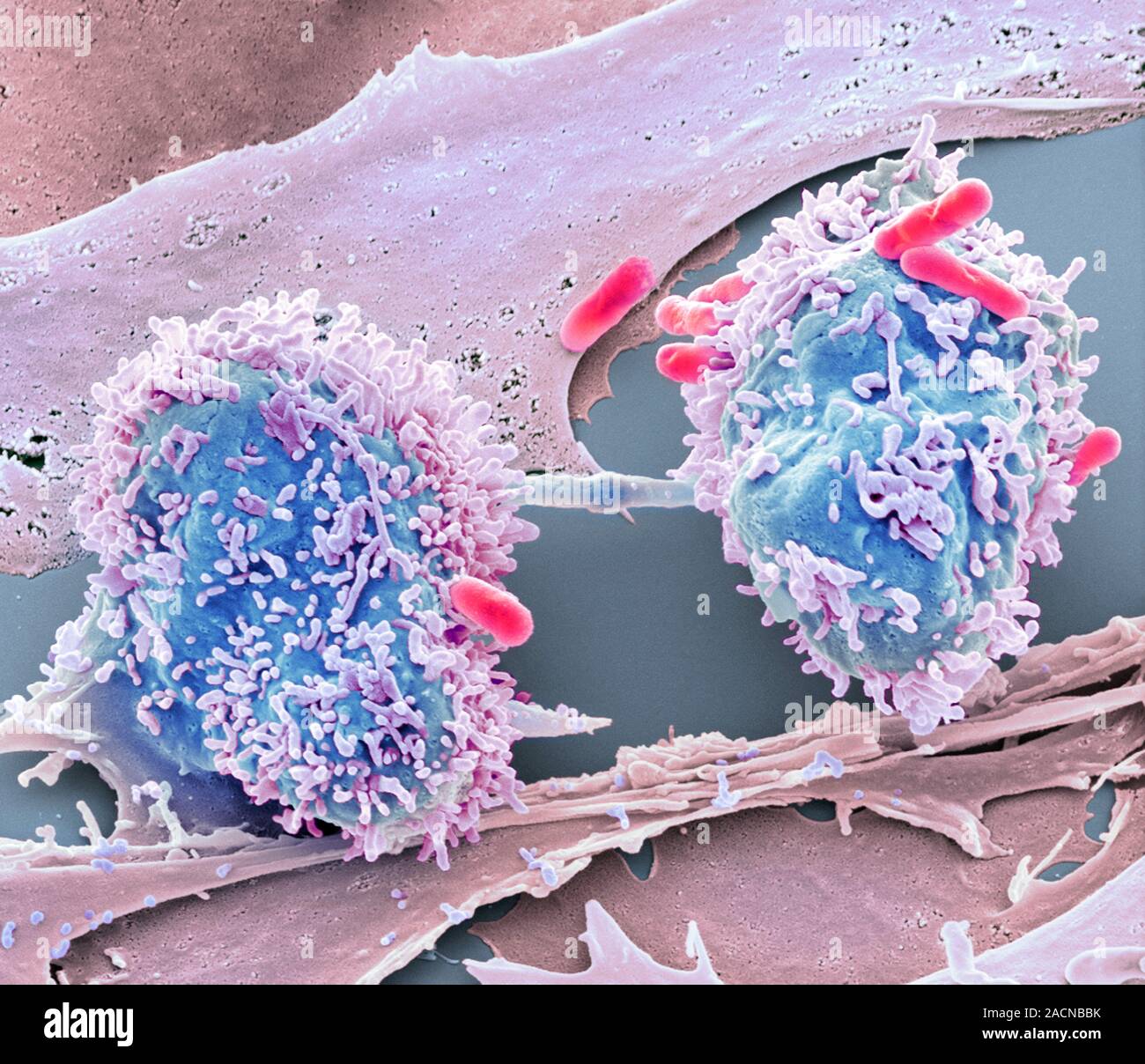 Dividing cancer cell. Coloured scanning electron micrograph (SEM) of a ...