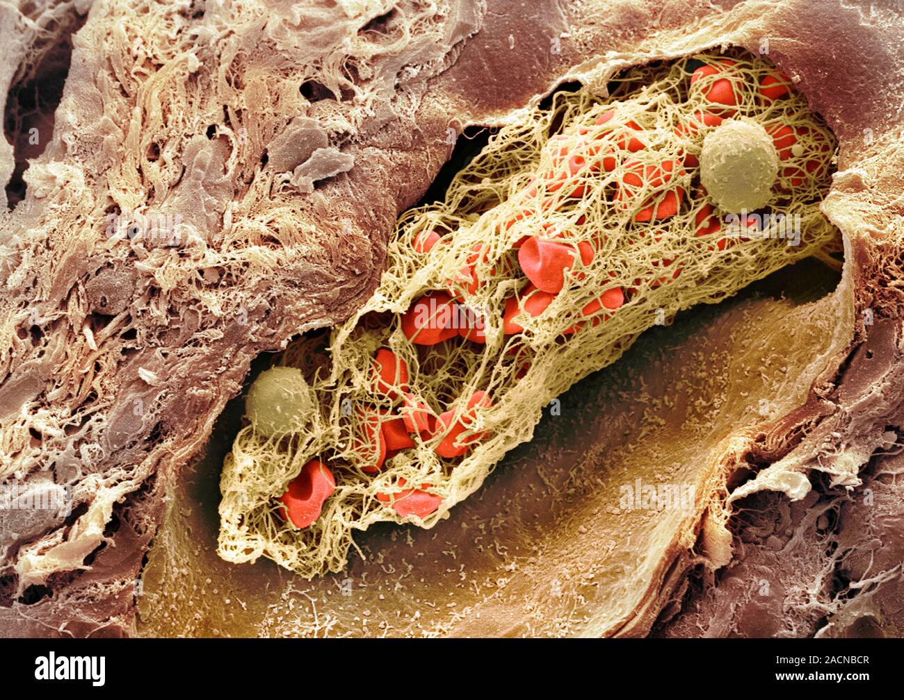 Blood clot. Coloured scanning electron micrograph (SEM) of a blood clot ...