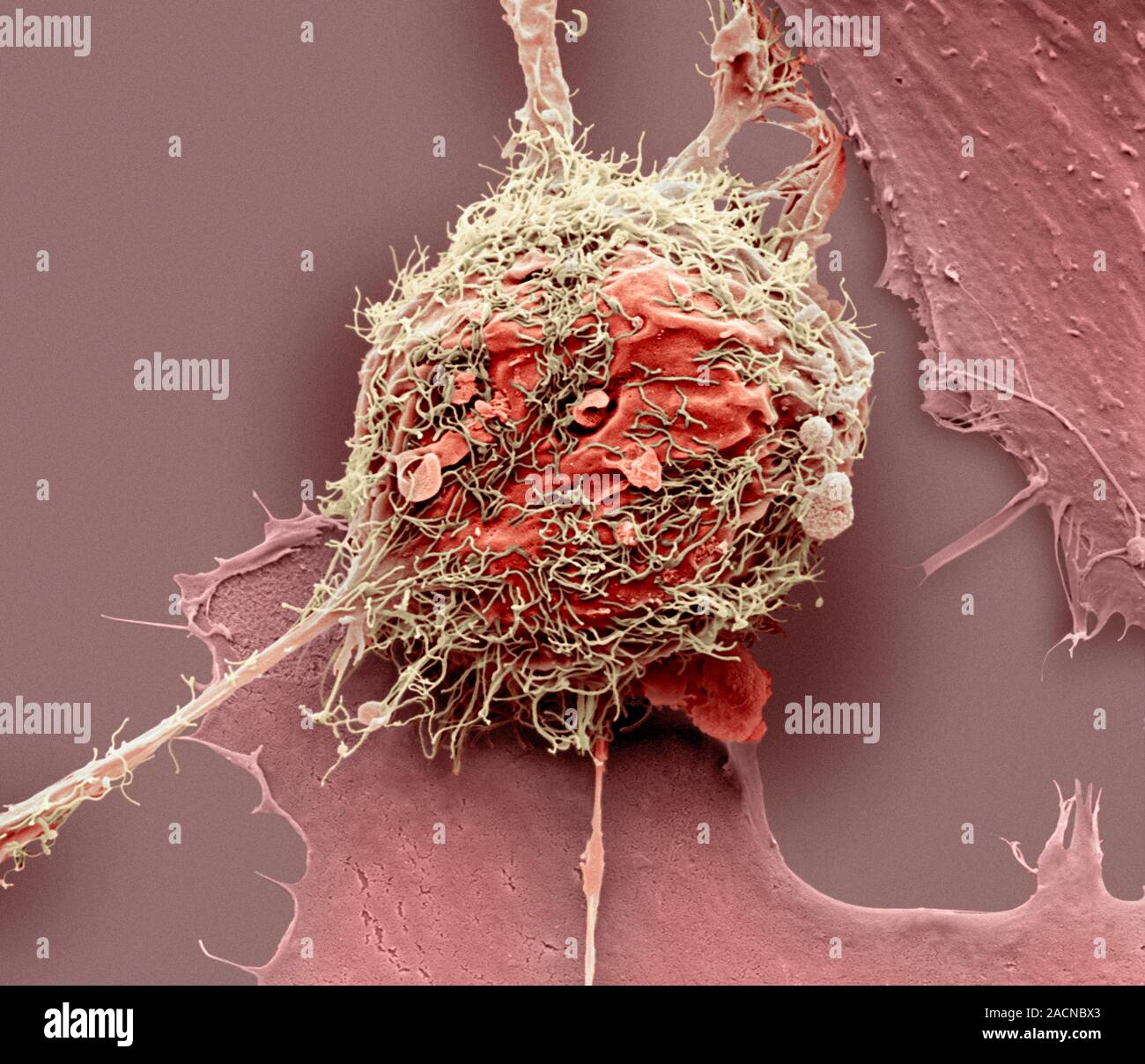 Bone cancer cell. Coloured scanning electron micrograph of a ...