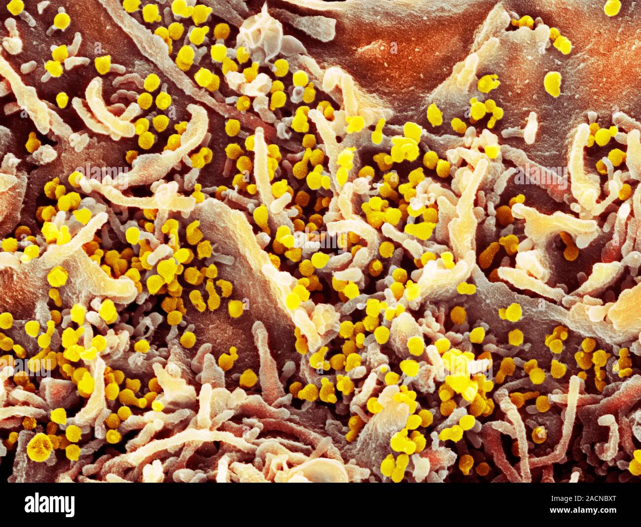 Cell infected with herpes virus. Coloured scanning electron micrograph ...
