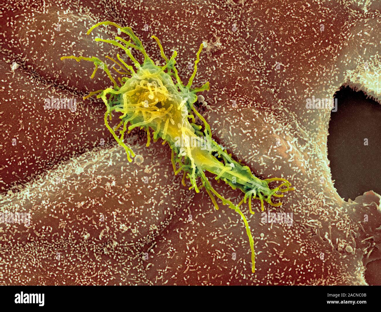 Cancer cell. Coloured scanning electron micrograph (SEM) of a carcinoma ...