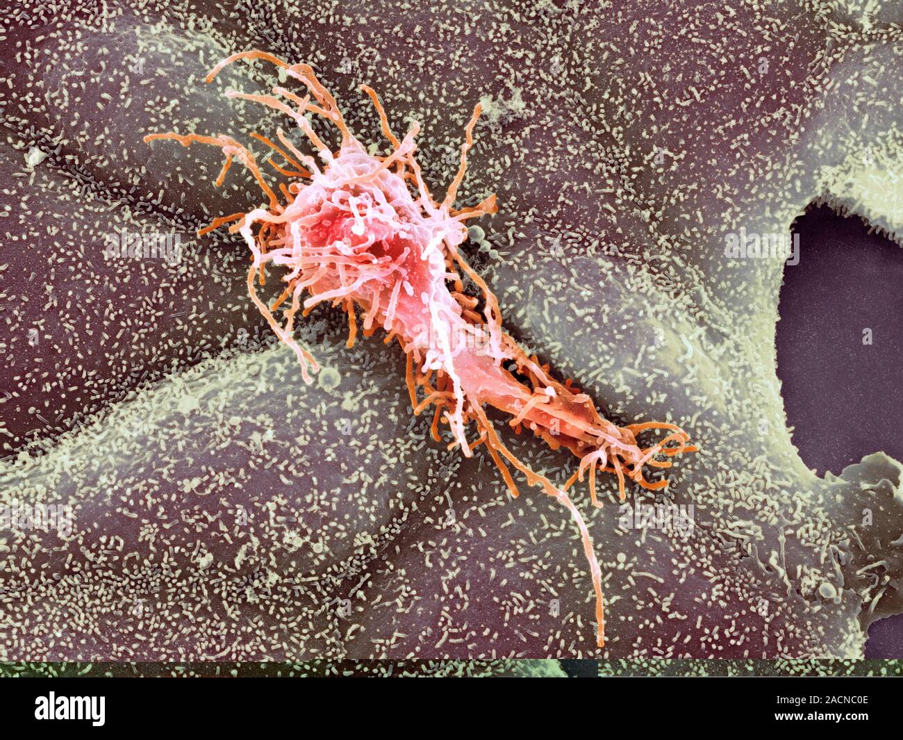 Cancer cell. Coloured scanning electron micrograph (SEM) of a carcinoma ...