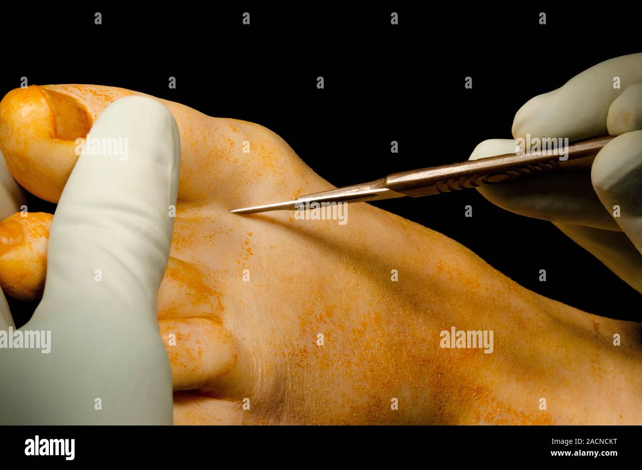 Foot surgery. Surgeon making an incision in the foot of a 50-year-old ...