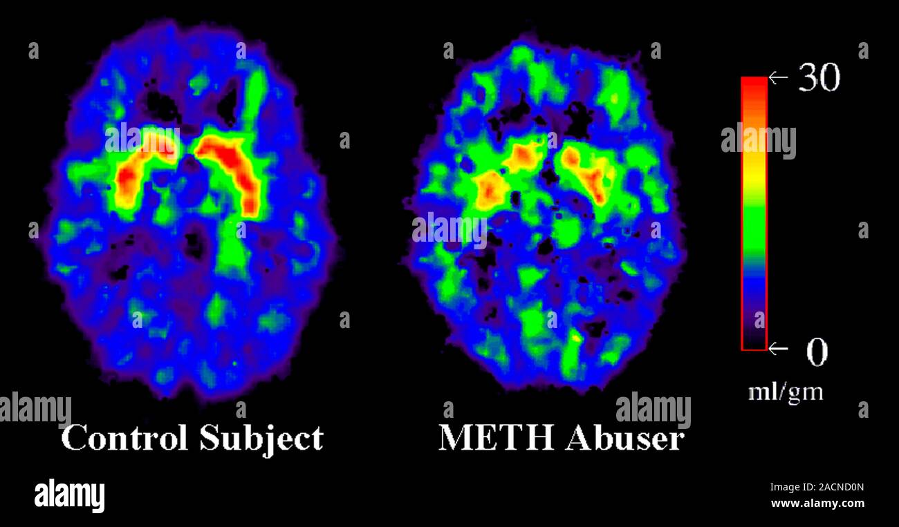Brain damage due to drugs, positron emission tomography (PET) scans ...