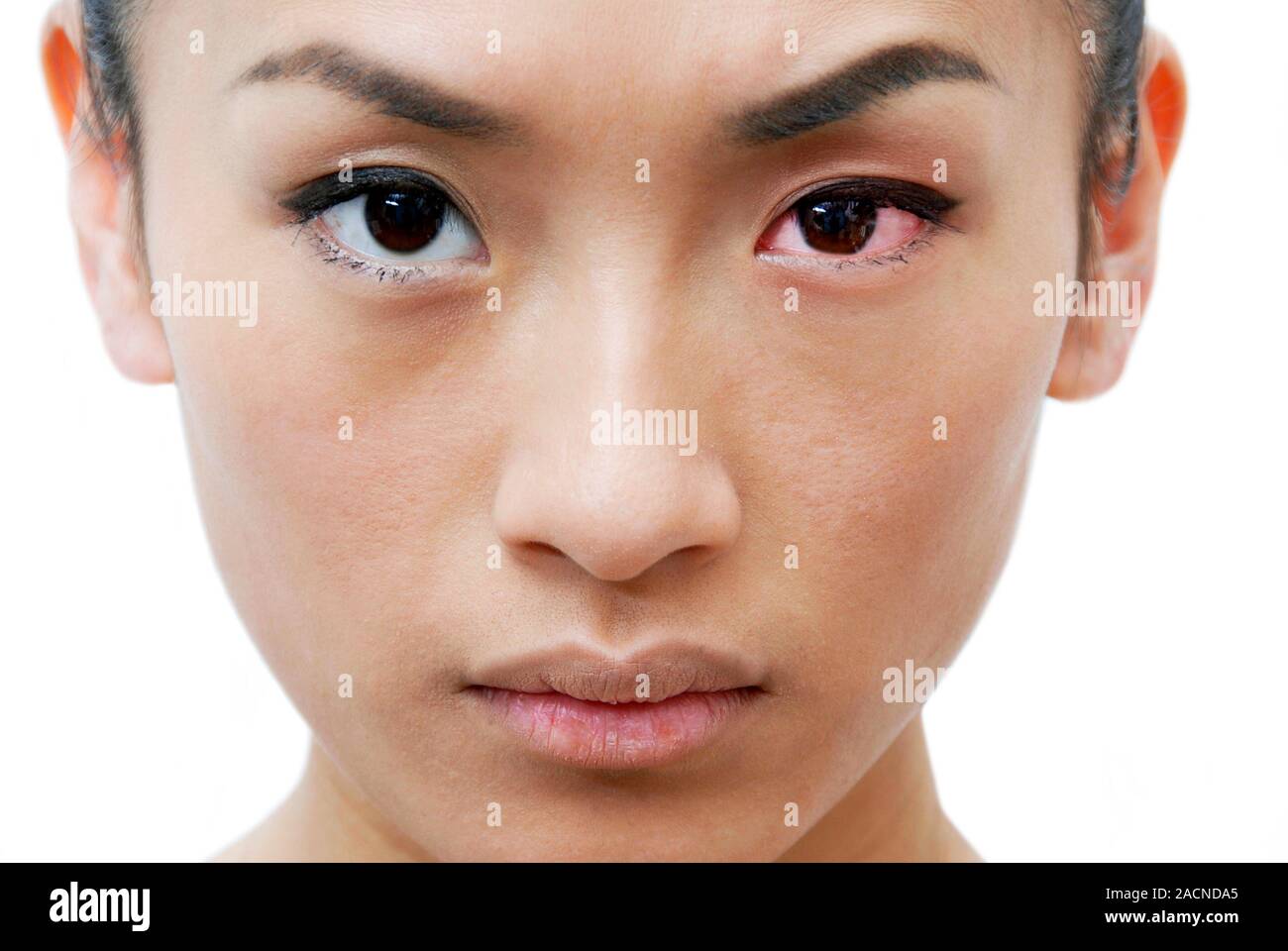 Conjunctivitis. Woman with an inflamed left eye (upper right) due to ...
