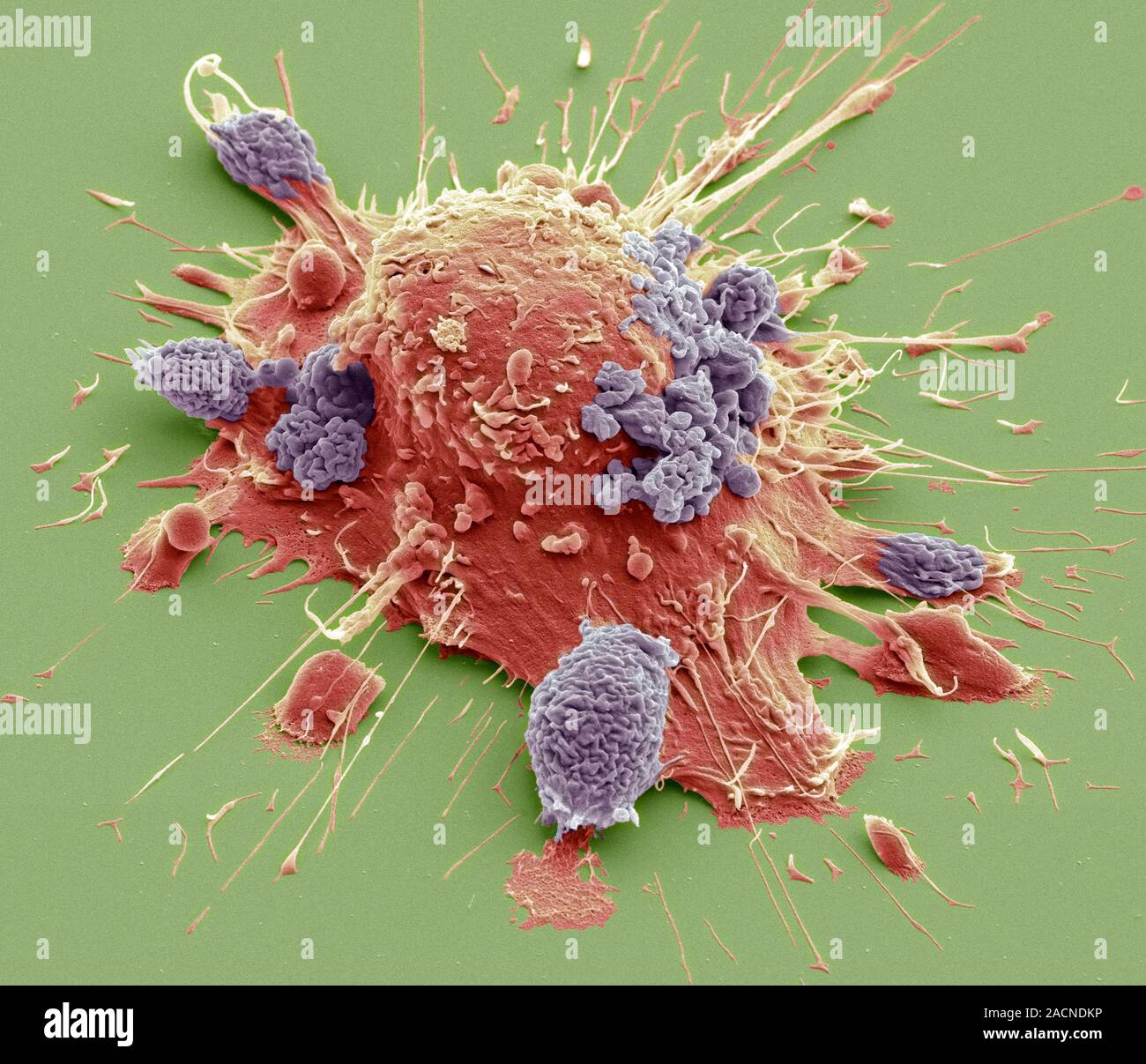 Mouth cancer cell. Coloured scanning electron micrograph (SEM) of a ...
