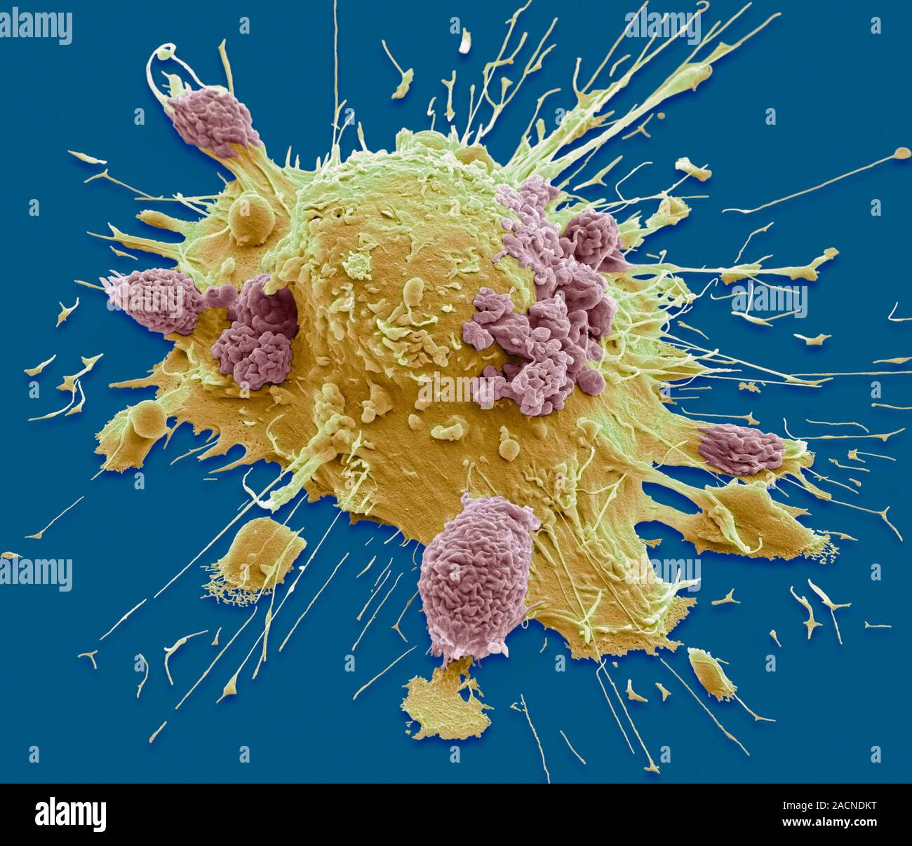 Mouth cancer cell. Coloured scanning electron micrograph (SEM) of a ...
