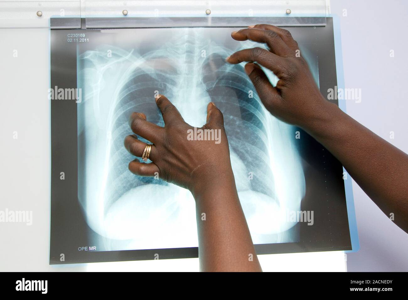 Tuberculosis (TB) X-ray diagnosis. Close-up of an X-ray of a patient's ...