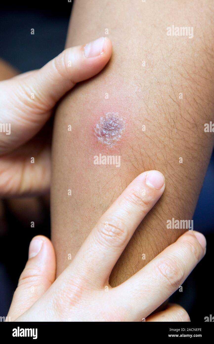 Tuberculosis (TB) testing. Close-up of an immune system response ...