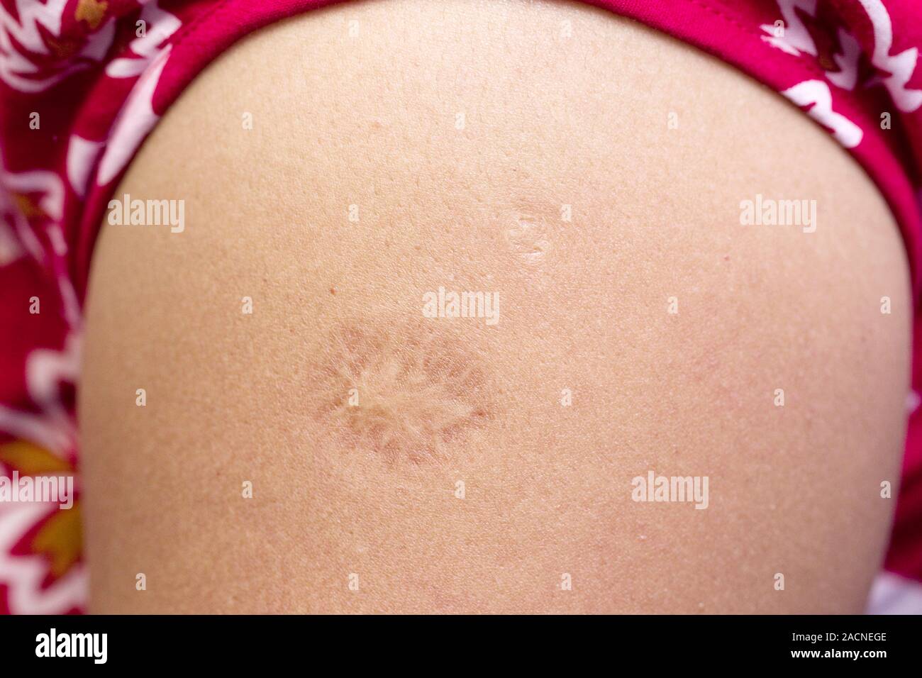 BCG vaccination scar on a patient's arm. BCG (Bacille Calmette-Guerin ...