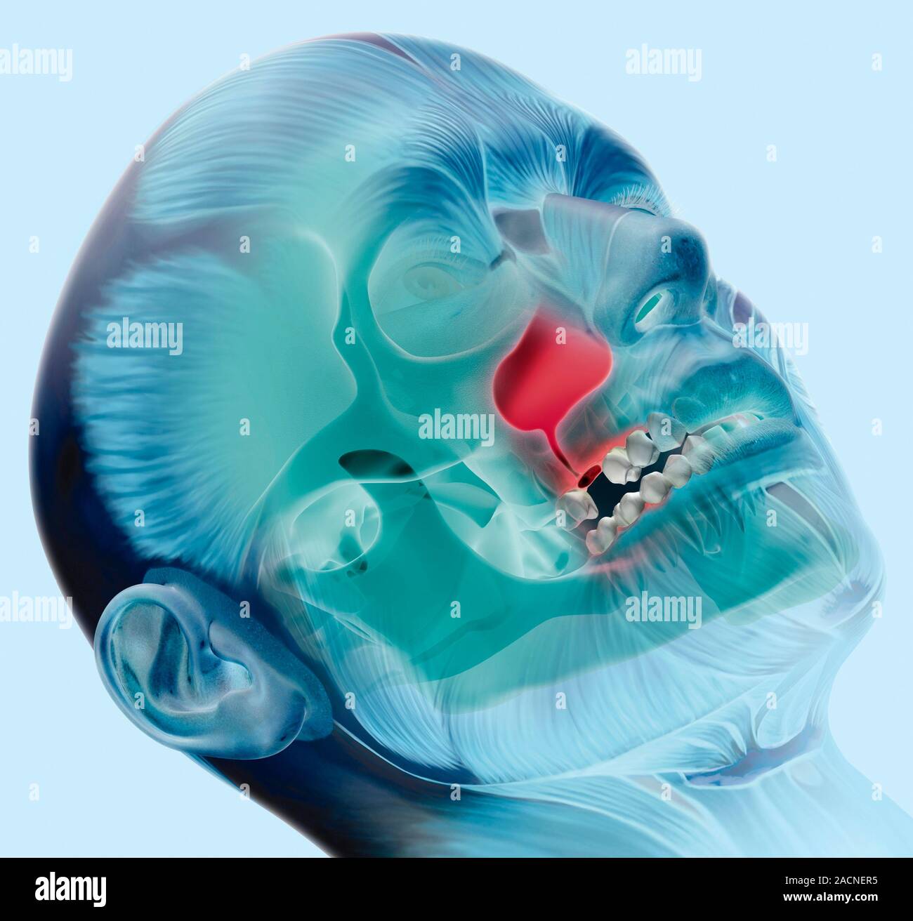 Oro-antral communication. Artwork of a human head showing a missing ...