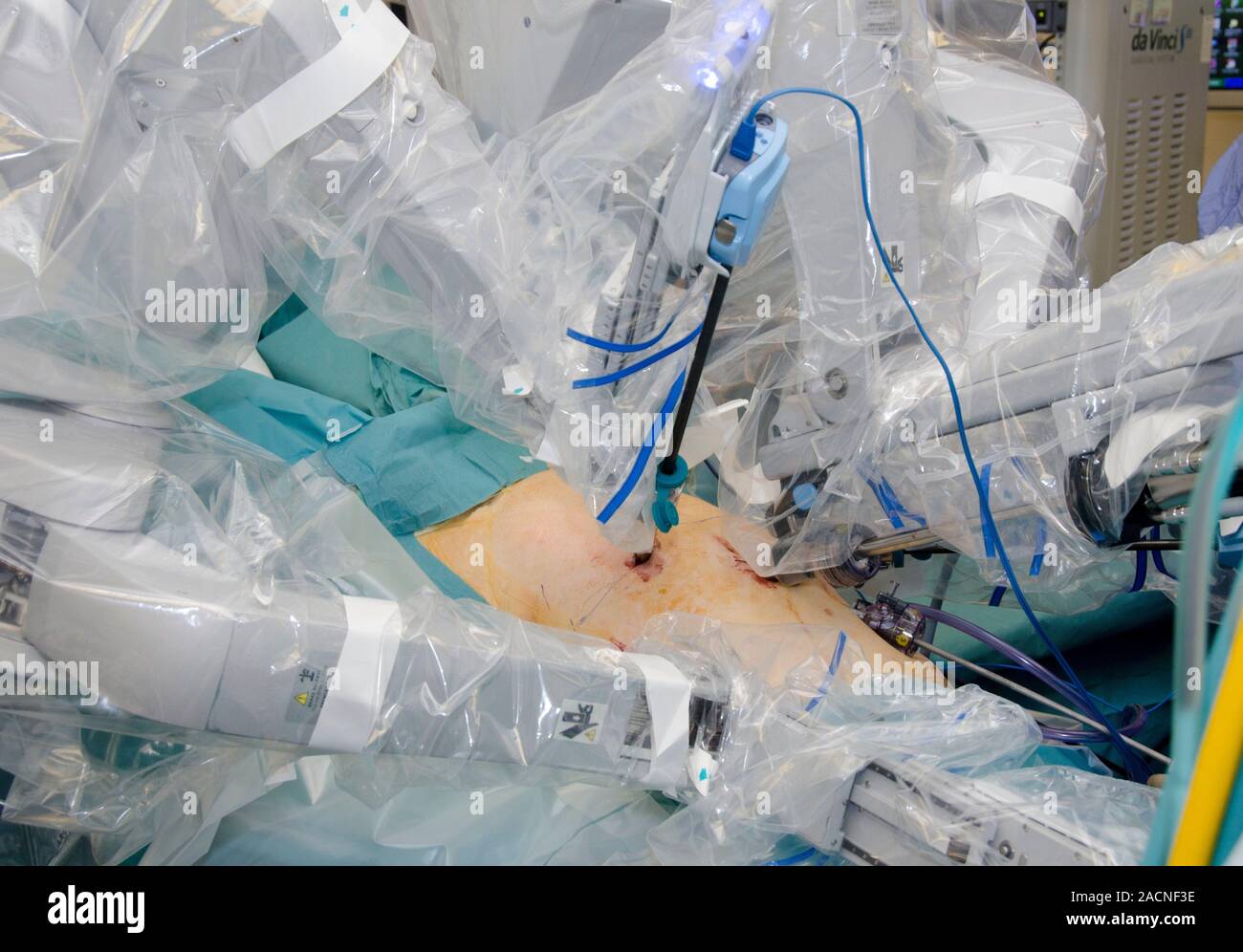 Robotic prostate cancer surgery. Da Vinci robot surgeon being used to ...