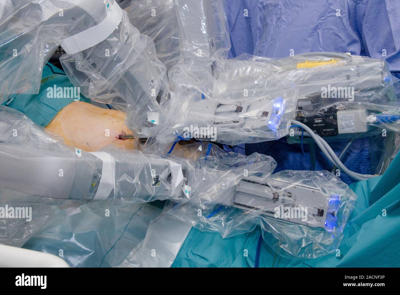 Robotic prostate cancer surgery. Da Vinci robot surgeon being used to ...