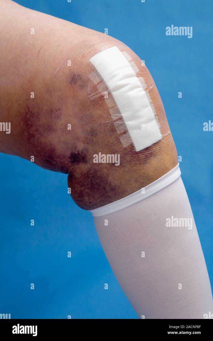 Knee of 75-year old woman one week after a partial knee replacement ...