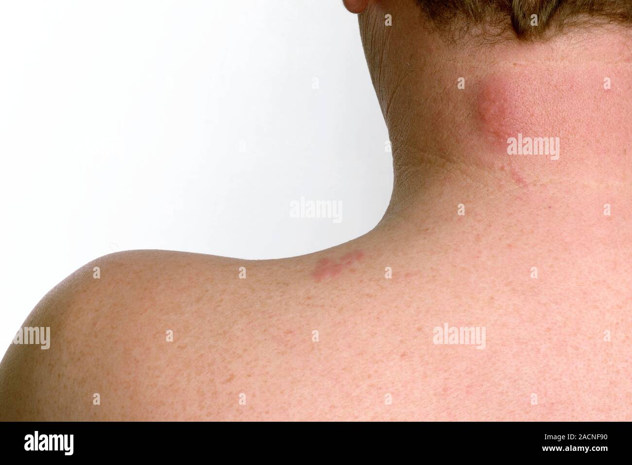 Not for use in Television Not for use in Television Rash of blisters ...