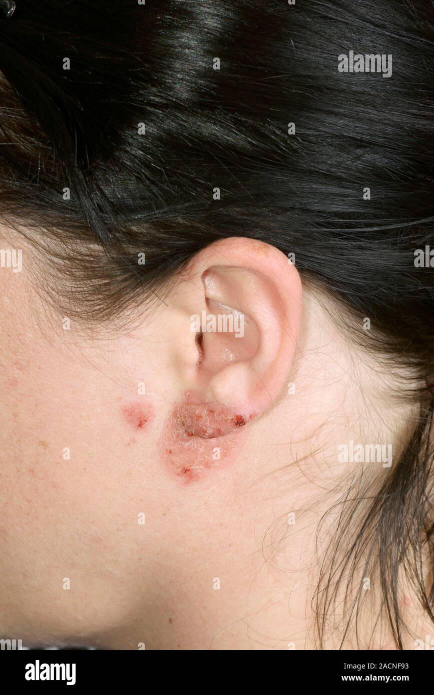 Not for use in Television Not for use in Television Encrusted sores on ...