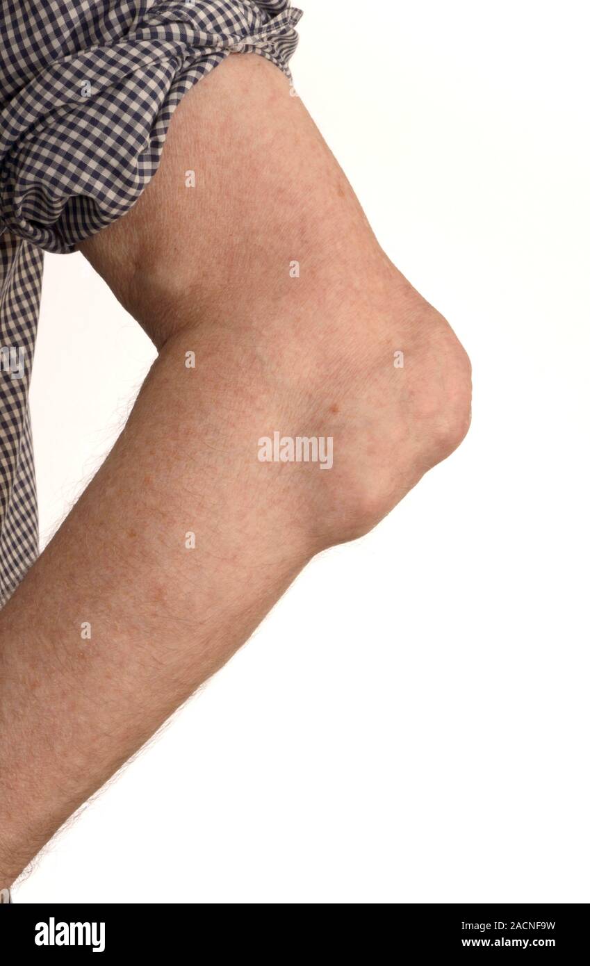 Not for use in Television Not for use in Television Swellings (tophi ...