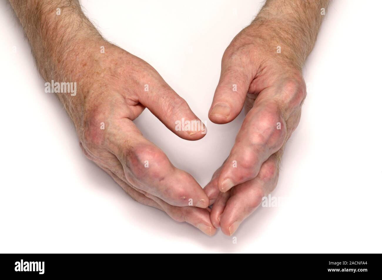 Not for use in Television Not for use in Television Swellings (tophi ...