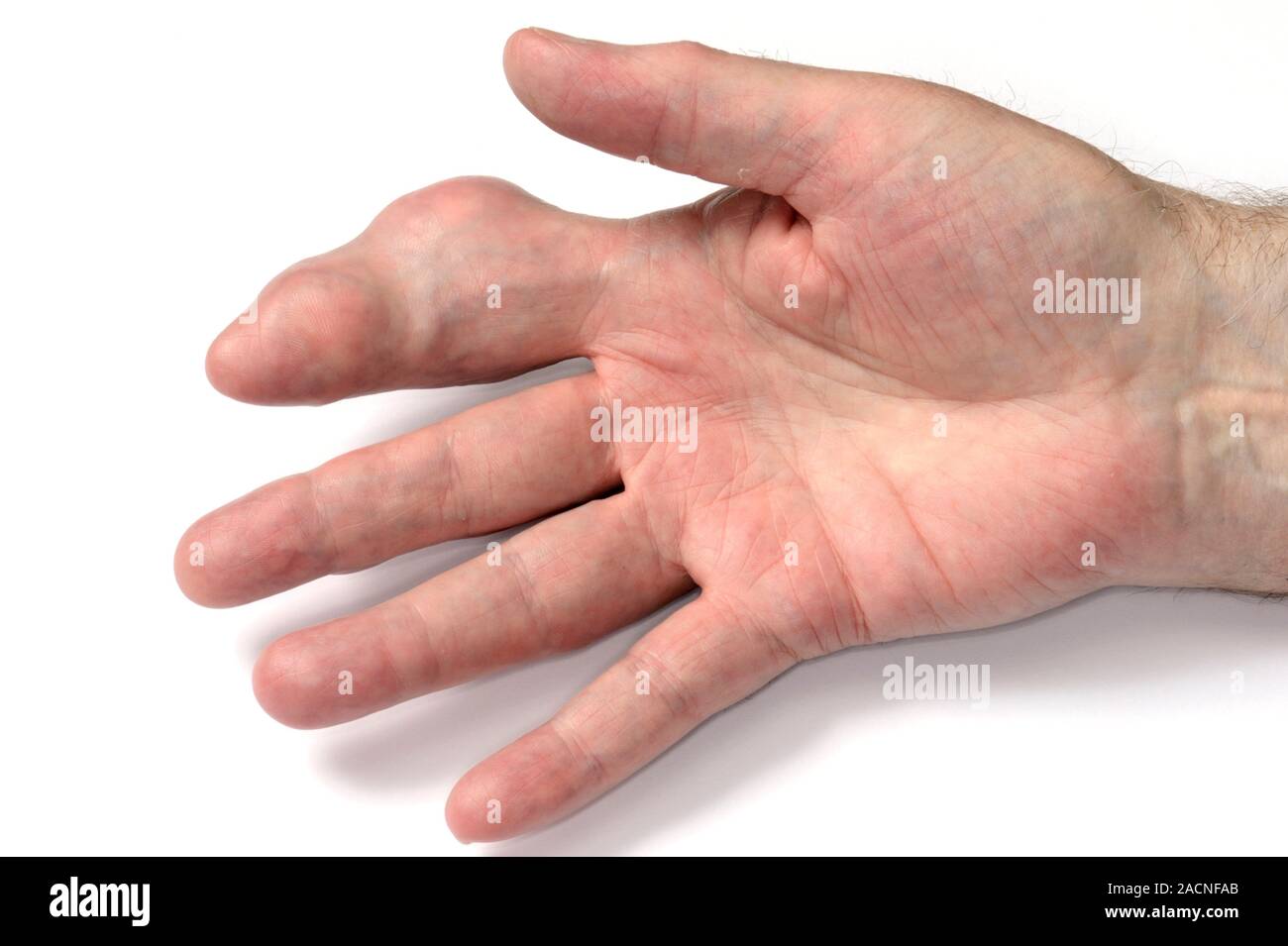 Not for use in Television Not for use in Television Swellings (tophi ...