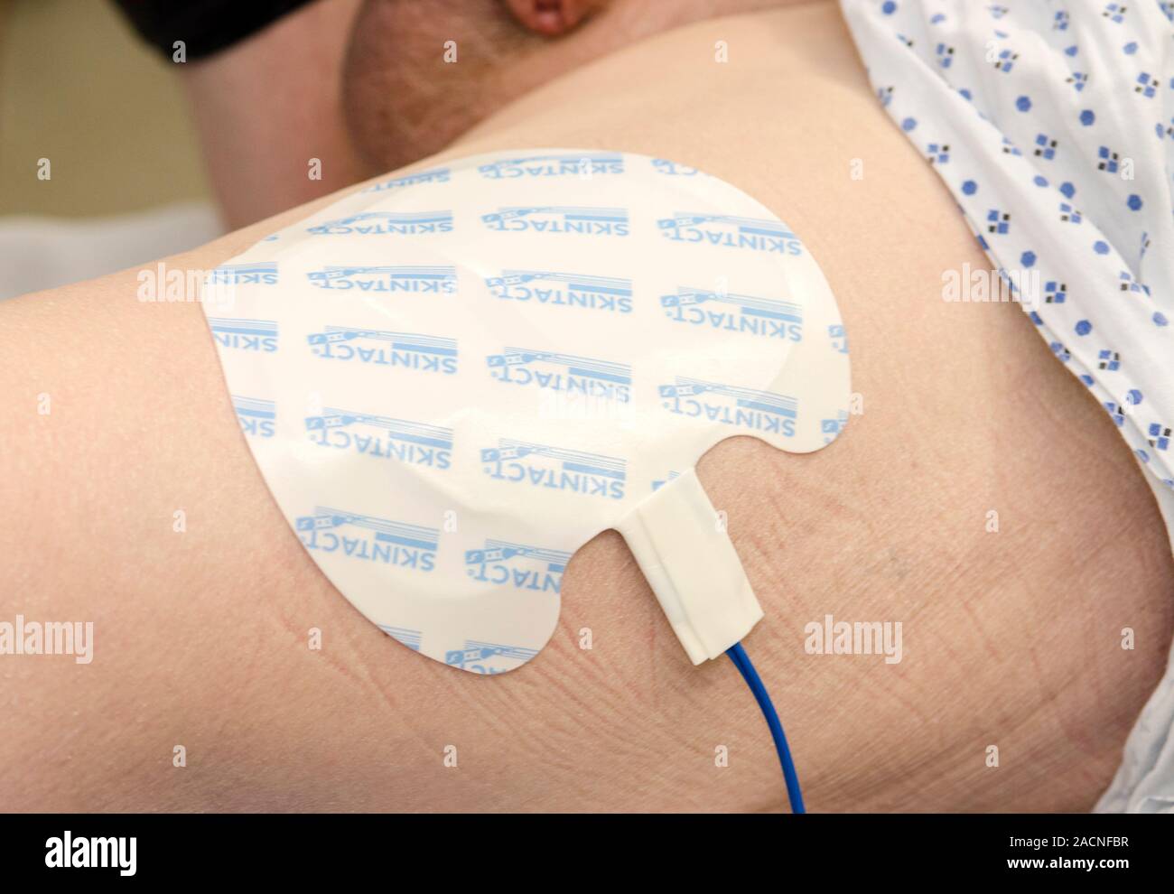 ECG electrode. Electrocardiogram (ECG) electrode on the leg of a male ...