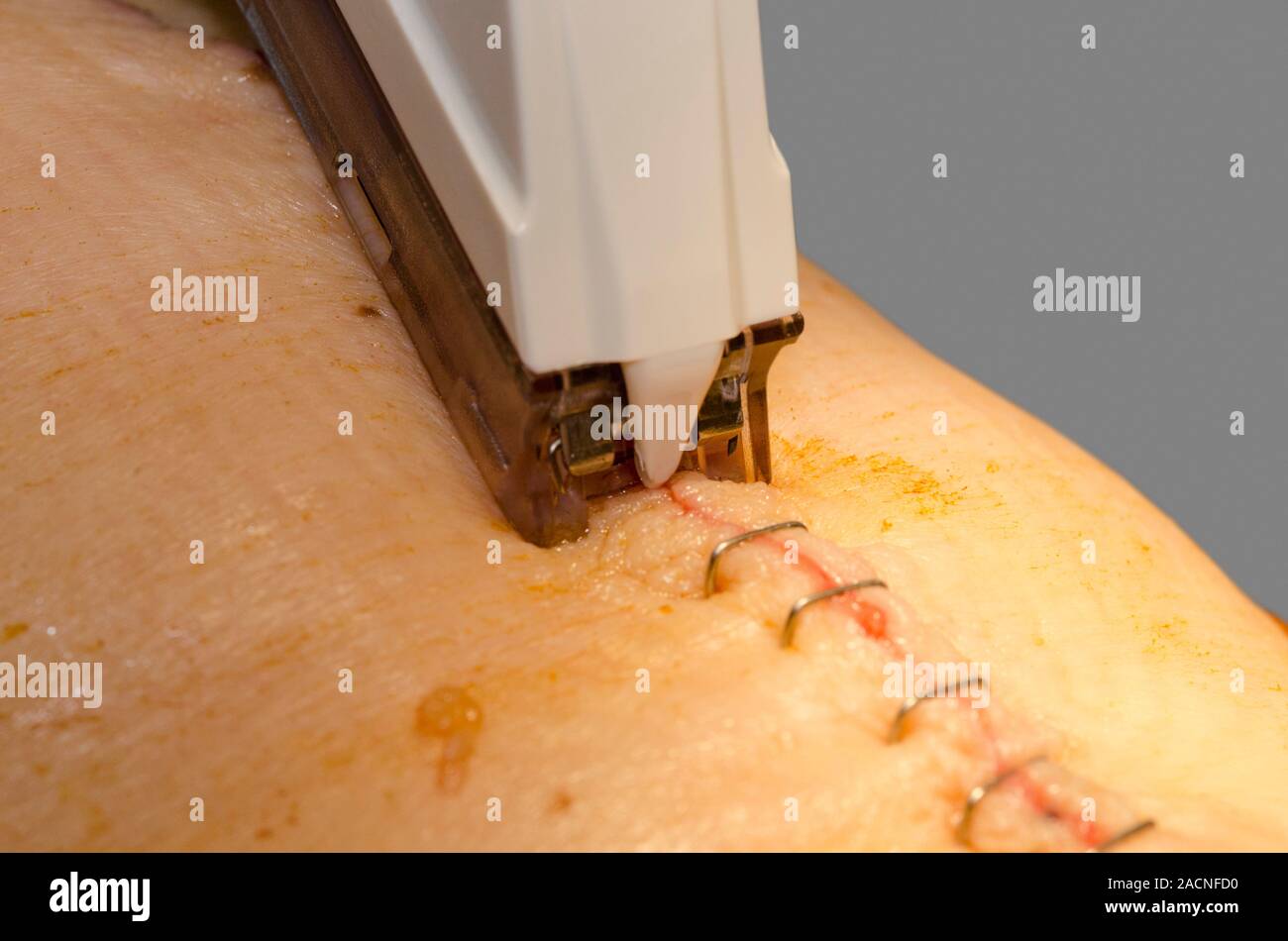 Knee replacement surgery. Surgeon stapling the incision after total ...