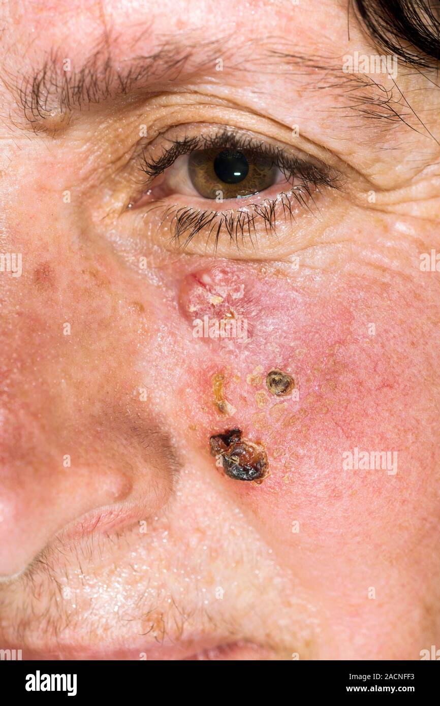 Close Up Of Basal Cell Carcinoma Bcc Or Rodent Ulcer On The Skin Of