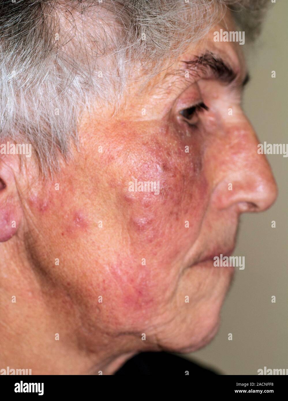 Side view of acne rosacea on the skin of the face in a female patient ...