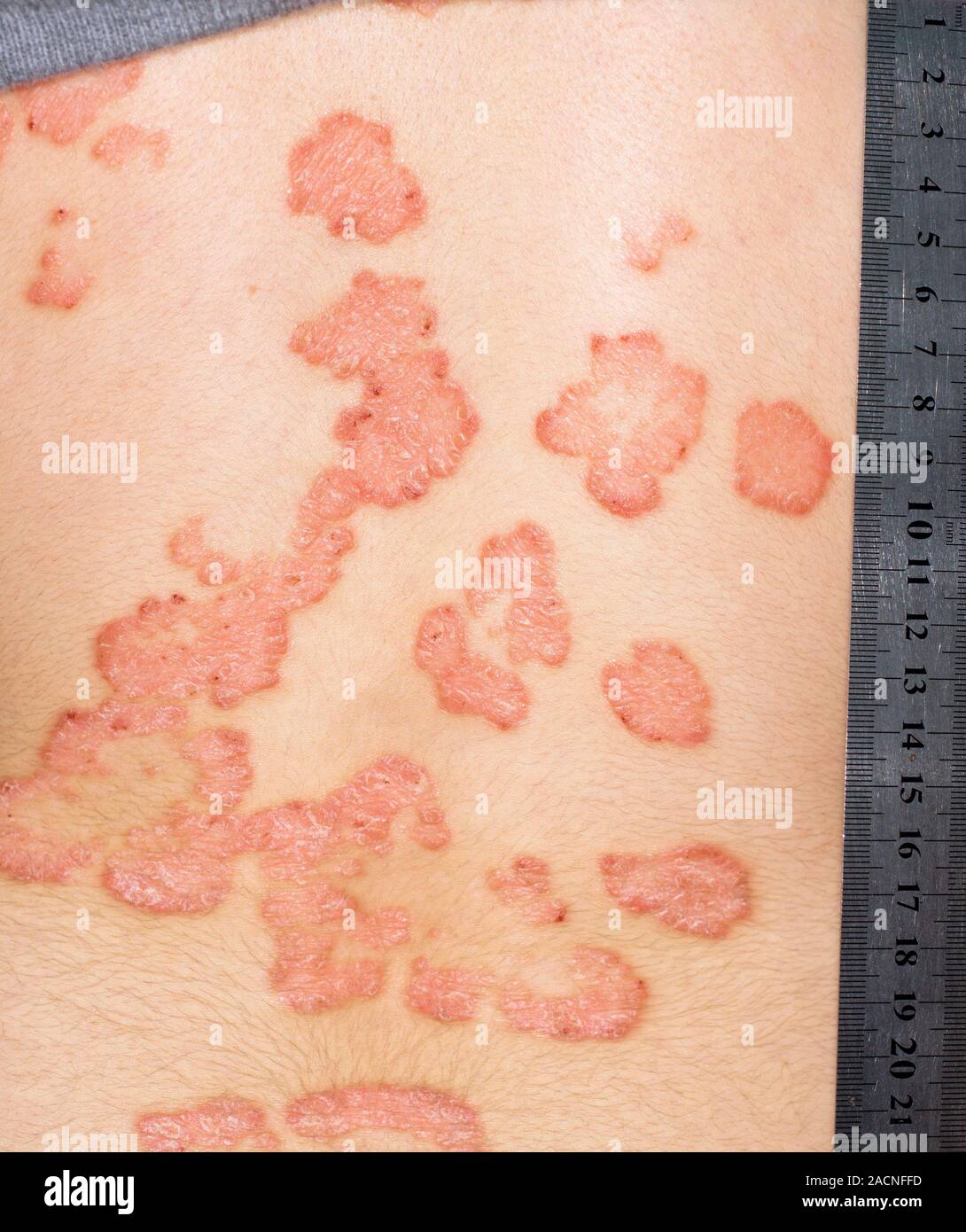 Psoriasis on the back during treatment. Psoriasis on the skin of the ...
