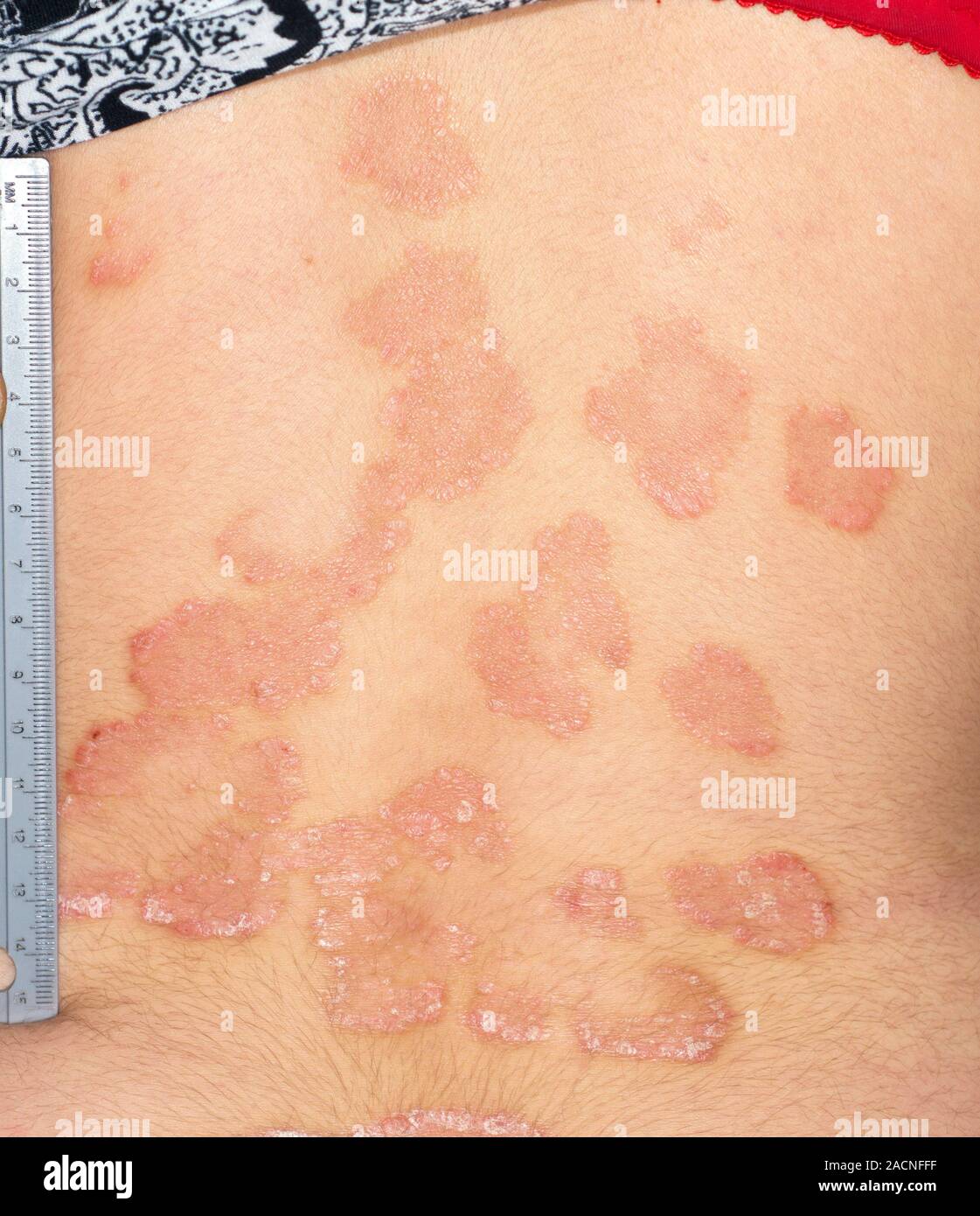 Psoriasis on the back after treatment. Psoriasis on the skin of the ...
