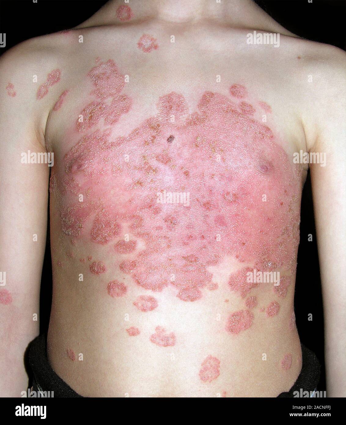 Red patches on the skin of the chest and abdomen in a young female patient due to fungal infection. Known as tinea corporis it is caused by various d Stock Photo