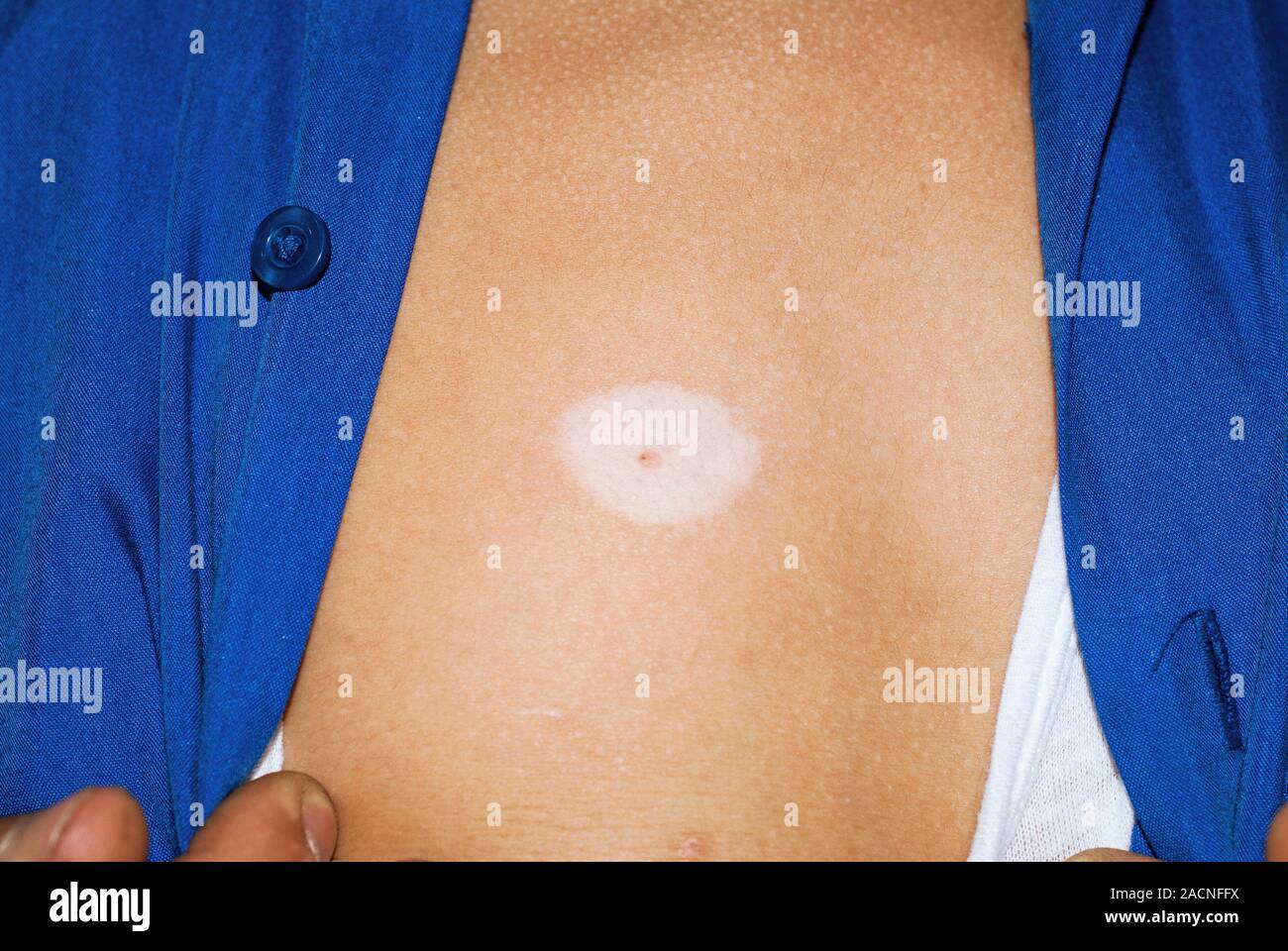 Halo naevus on the skin of the upper chest in a young female patient ...